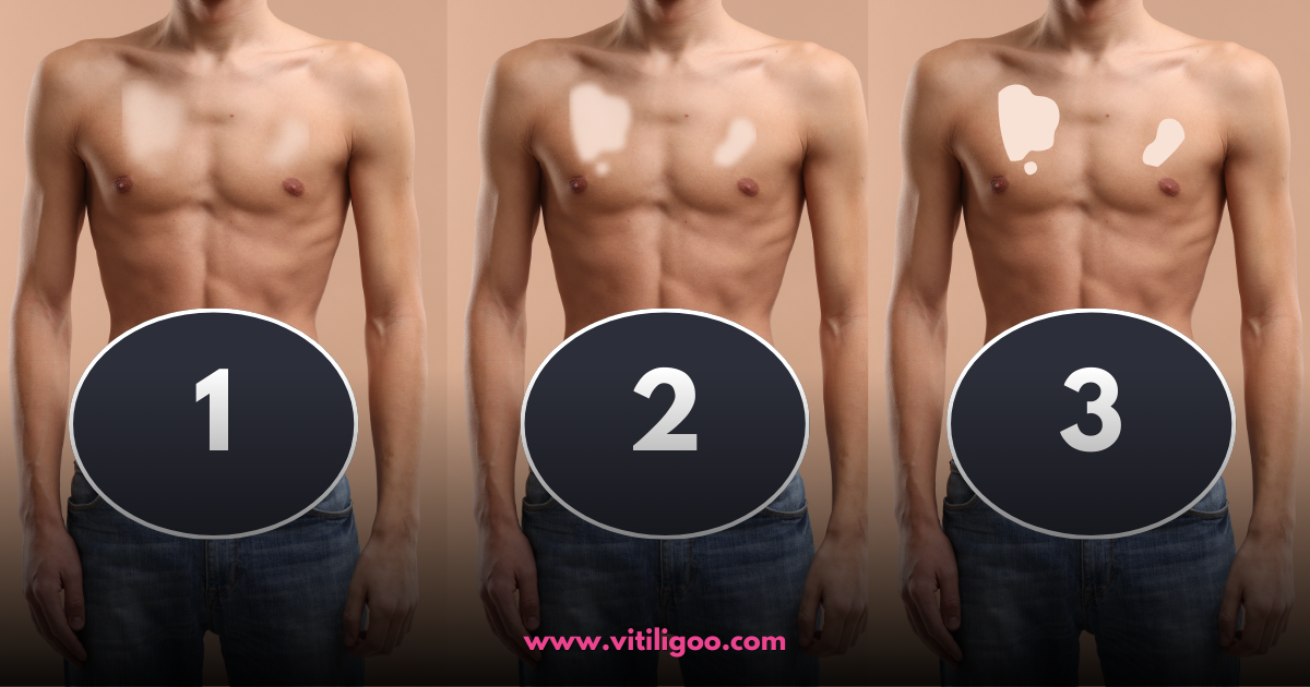 How Does Vitiligo Start appearing on Skin? - Vitiligoo