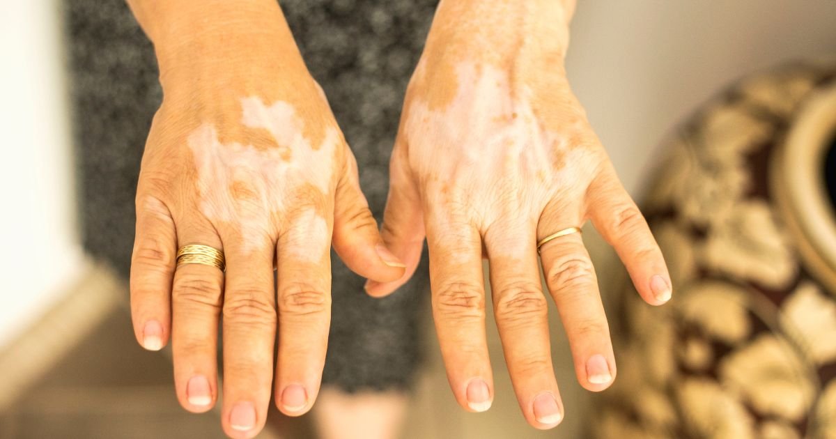 Vitiligo - Types, Symptoms, Causes, Treatment Options, Myths and more ...
